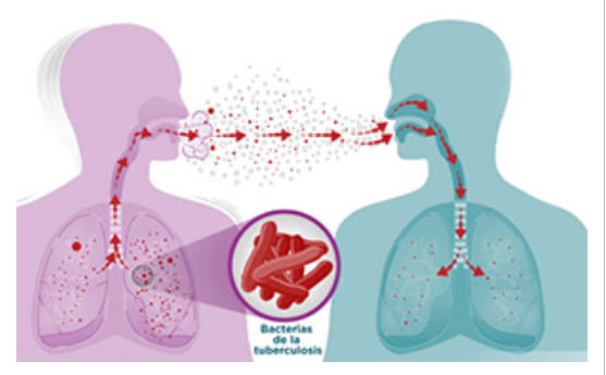 Medellín es la ciudad con más casos de tuberculosis en Colombia: ¿cómo ...