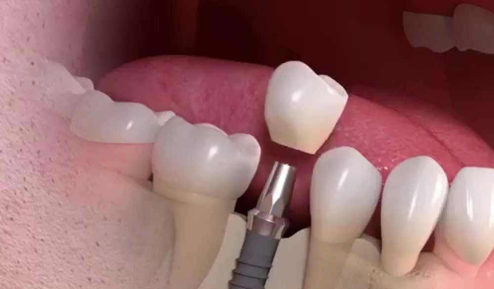 How Do My New False Teeth Function? - Andrea Echeverri