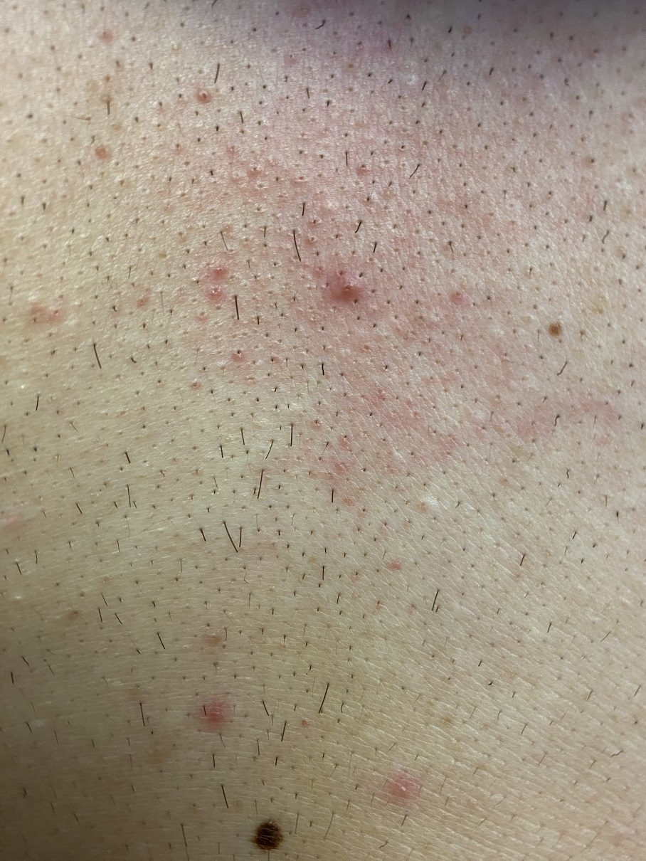 Is it normal for some chest hair not to shed two weeks after my first ...