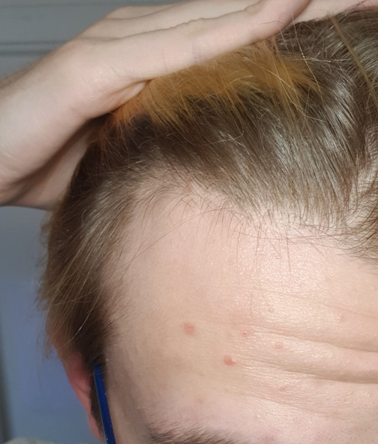 [*not so* Weekly Progress Log] 20yo male, receding, 1.5mm dermaroll ...